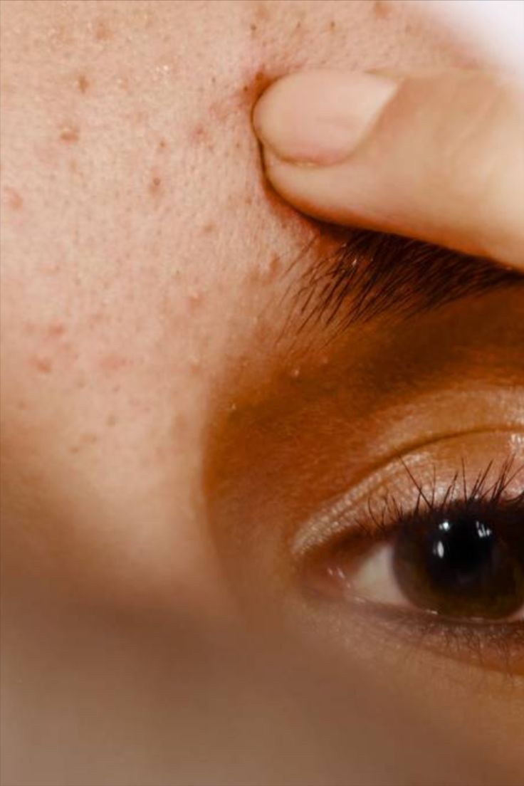 Dilated pores – NeoVitale